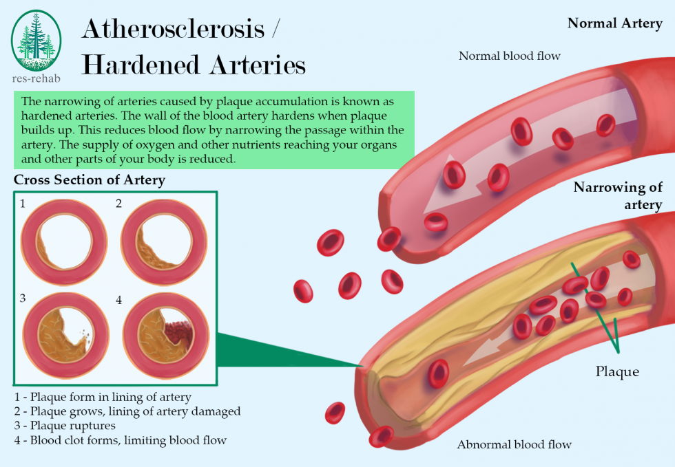 Atherosclerosis | res-rehab