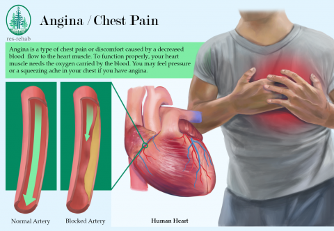 Chest Pain | res-rehab